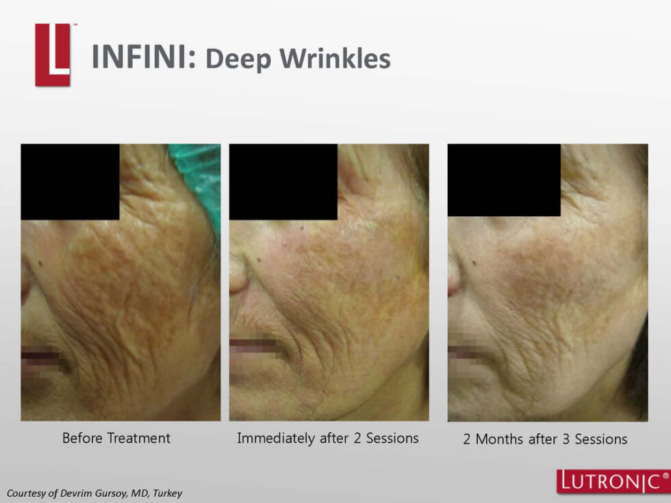 Microneedling & RF Microneedling | INFINI by Cynosure Lutronic